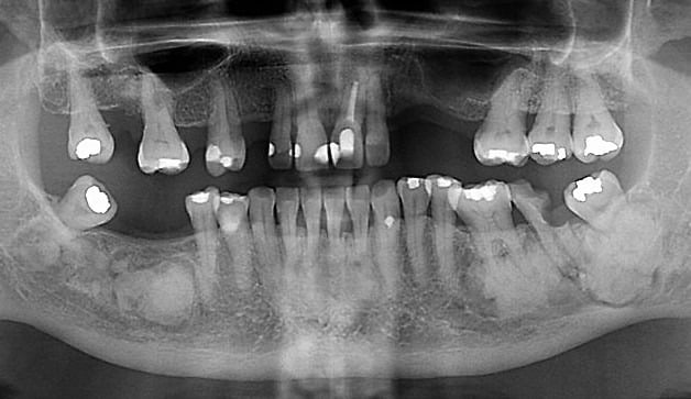 Doenca De Paget Da Mandibula Clinical Image Of A Patient Who Was On IV